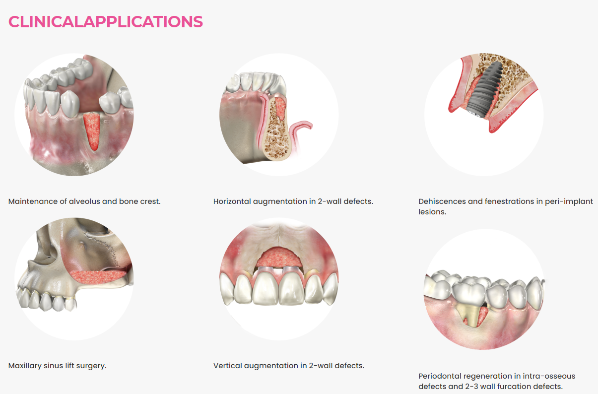 STARTER PACKAGE Bone substitute & collagen membrane