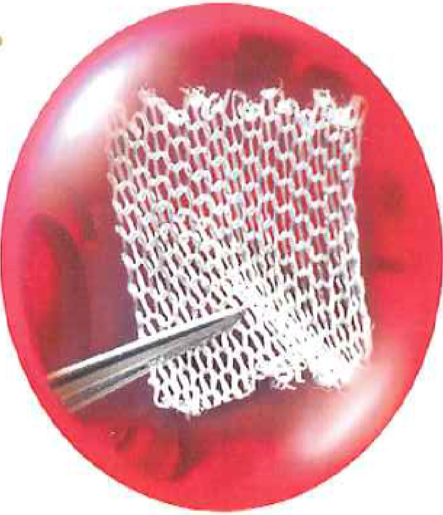 Surgicel 1,25 x 5 cm resorbable hemostatic stops bleeding