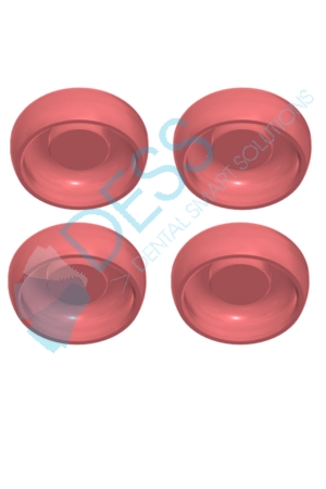 DESS Locator® Retention Kit