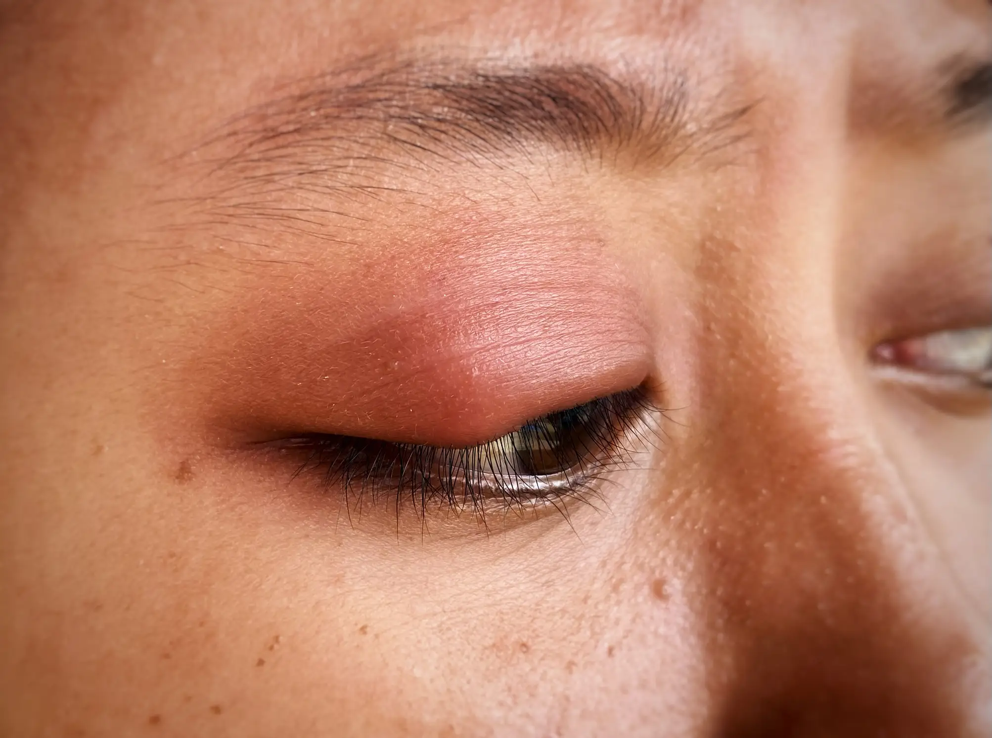 Svullet ögonlock - Mediconline