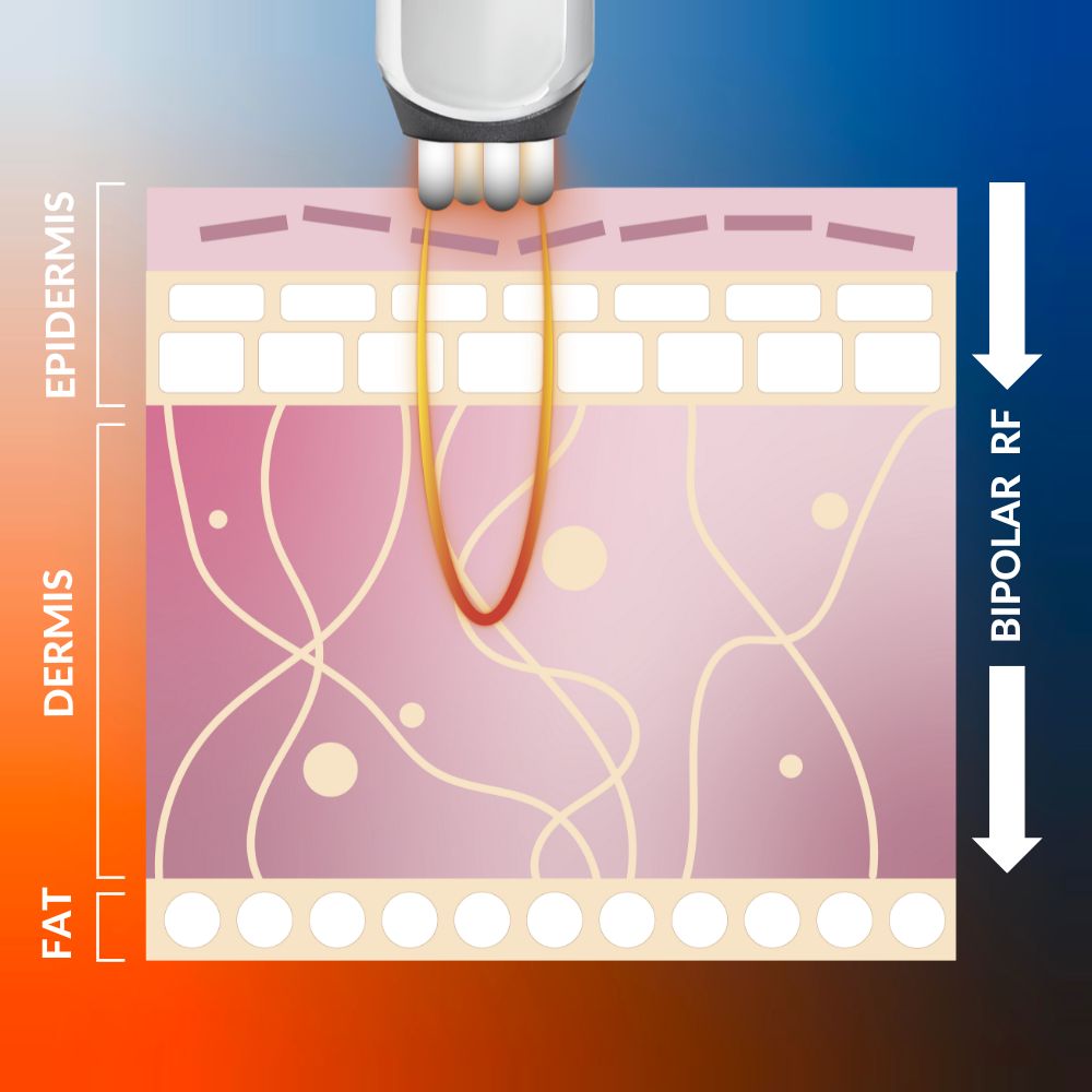 CurrentBody Skin RF Radio Frequency Skin Tightening Device - Basic Instinct
