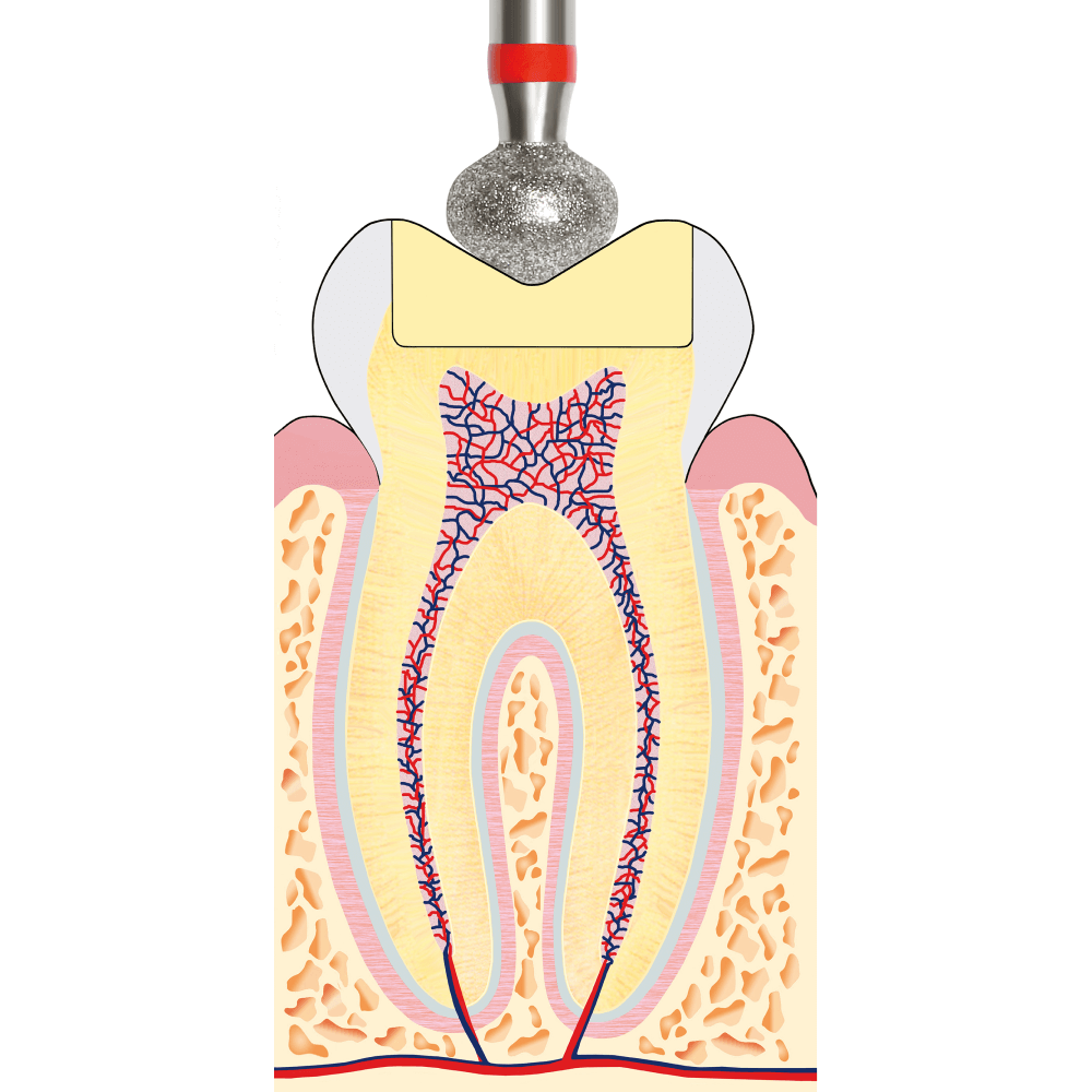 NTI - LazyBur (gul-superfin) - 986-031SF-FG - 5-pack - Denthouse AB