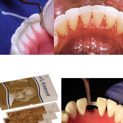 klardent.se - Ribbond THM 68cm x 2mm Retention Thread