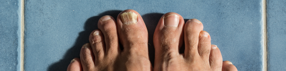 Kynsisieni kuvia - Miltä kynsisieni näyttää? - Jalka akuutti